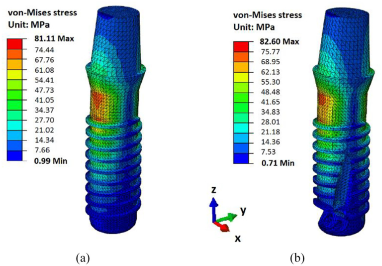 How Metal 3D Printing Makes Perfect-Fit Dental Implants: A Technical ...